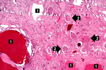 IPLab:Lab 5:Polycystic Kidney Disease - Pathology Education ...