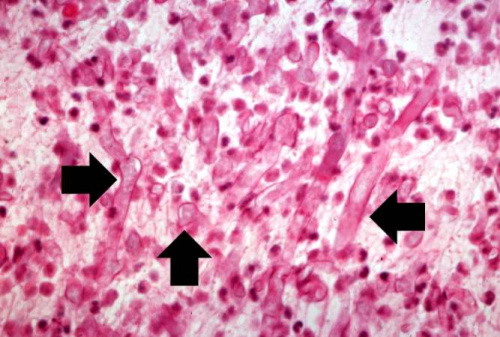 IPLab:Lab 10:Mucormycosis - Pathology Education Instructional Resource