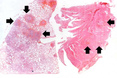 IPLab:Lab 4:Septic Emboli - Pathology Education Instructional Resource