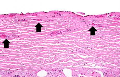 IPLab:Lab 12:Burns - Pathology Education Instructional Resource