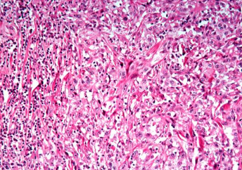 IPLab:Lab 7:Lip SCC - Pathology Education Instructional Resource