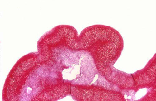 IPLab:Lab 13:Meningococcemia - Pathology Education Instructional Resource