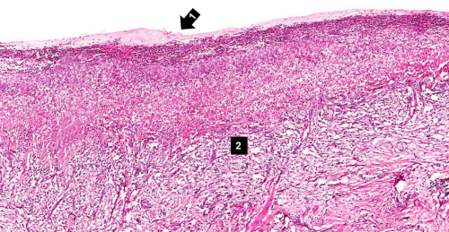 IPLab:Lab 3:Chronic Peptic Ulcer - Pathology Education Instructional ...