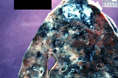 IPLab:Lab 6:Tuberculosis - Pathology Education Instructional Resource