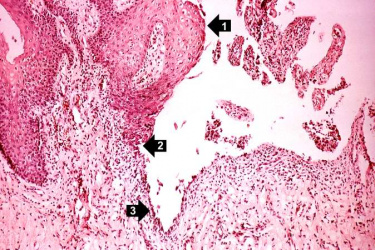 IPLab:Lab 8:HSV Glossitis - Pathology Education Instructional Resource