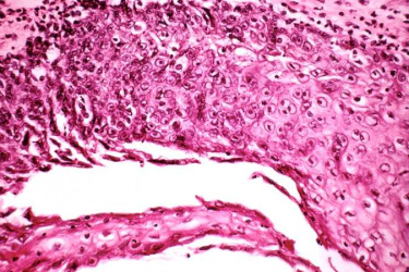 IPLab:Lab 8:HSV Glossitis - Pathology Education Instructional Resource