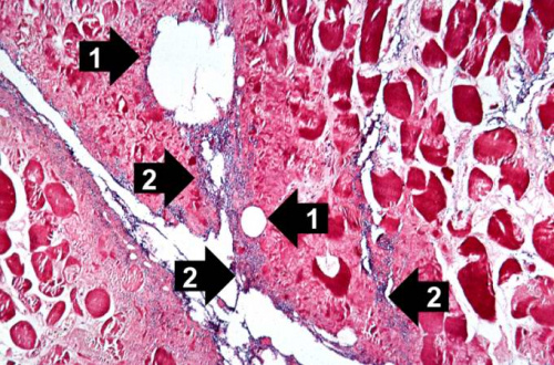 IPLab:Lab 9:Clostridial Myonecrosis - Pathology Education Instructional ...