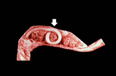 IPLab:Lab 11:Ascariasis - Pathology Education Instructional Resource