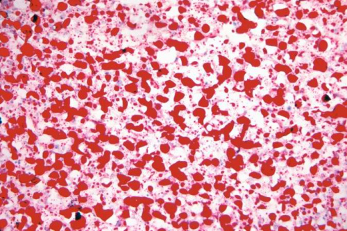 IPLab:Lab 2:Fatty Change and Cirrhosis - Pathology Education ...