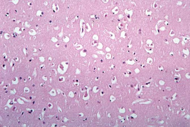 IPLab:Lab 9:Bacterial Meningitis - Pathology Education Instructional ...
