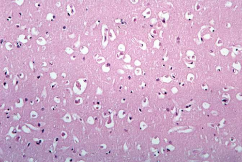 IPLab:Lab 9:Bacterial Meningitis - Pathology Education Instructional ...