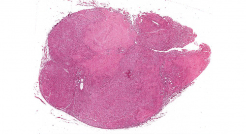 IPLab:Lab 10:Histoplasmosis - Pathology Education Instructional Resource