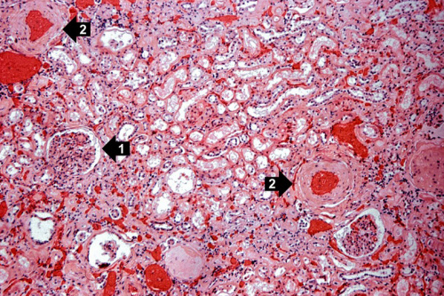 IPLab:Lab 5:Nodular Intercapillary Glomerulosclerosis - Pathology ...