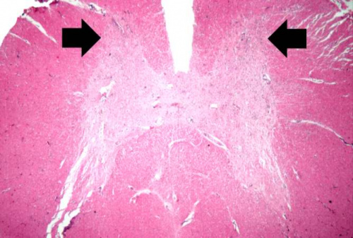 IPLab:Lab 8:Poliomyelitis - Pathology Education Instructional Resource