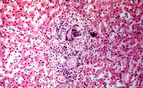 IPLab:Lab 11:Schistosomiasis - Pathology Education Instructional Resource