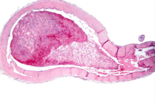 IPLab:Lab 10:Mucormycosis - Pathology Education Instructional Resource
