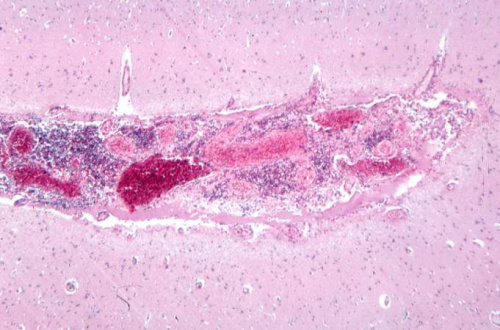 IPLab:Lab 9:Bacterial Meningitis - Pathology Education Instructional ...
