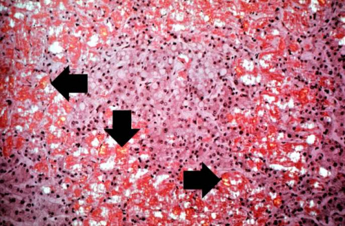IPLab:Lab 6:Amyloidosis - Pathology Education Instructional Resource