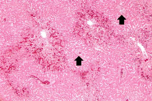 IPLab:Lab 4:Chronic Passive Congestion - Pathology Education ...