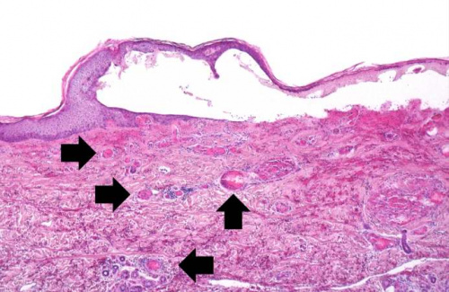 IPLab:Lab 12:Acetaminophen Toxicity - Pathology Education Instructional ...