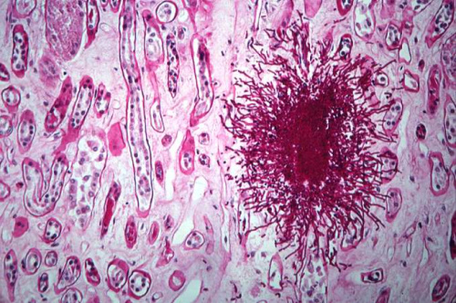 IPLab:Lab 10:Candidiasis - Pathology Education Instructional Resource
