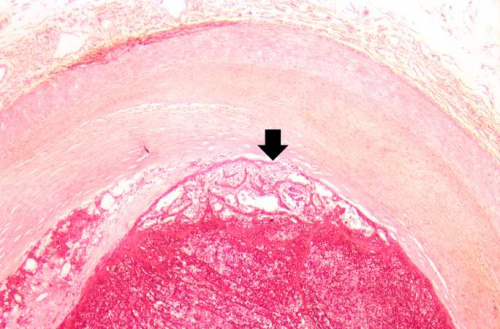IPLab:Lab 4:Thrombosis - Pathology Education Instructional Resource