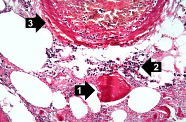 IPLab:Lab 9:Clostridial Myonecrosis - Pathology Education Instructional ...
