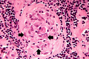 IPLab:Lab 3:Sarcoidosis - Pathology Education Instructional Resource