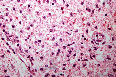 IPLab:Lab 8:Poliomyelitis - Pathology Education Instructional Resource