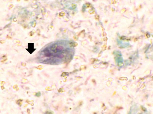 IPLab:Lab 11:Ascariasis - Pathology Education Instructional Resource