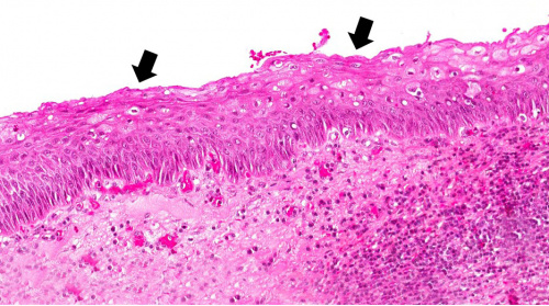 IPLab:Lab 2:Metaplasia - Pathology Education Instructional Resource