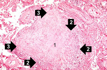 IPLab:Lab 3:Tuberculosis - Pathology Education Instructional Resource