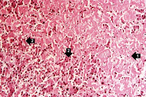IPLab:Lab 6:Amyloidosis - Pathology Education Instructional Resource
