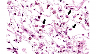 IPLab:Lab 3:Brain Infarction - Pathology Education Instructional Resource