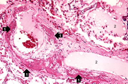 IPLab:Lab 2:Metastatic Calcification - Pathology Education ...