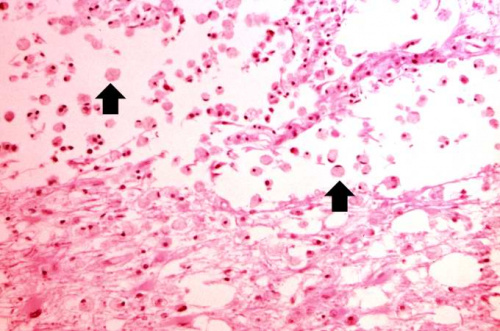 IPLab:Lab 3:Brain Infarction - Pathology Education Instructional Resource