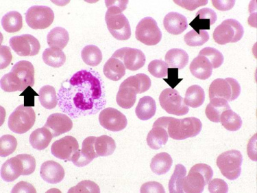 IPLab:Lab 11:Malaria - Pathology Education Instructional Resource