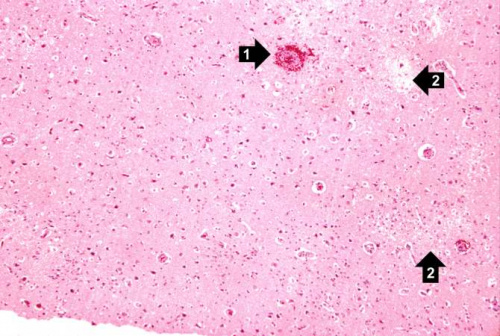 IPLab:Lab 8:HSV Encephalitis - Pathology Education Instructional Resource