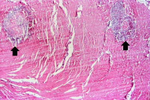 IPLab:Lab 4:Septic Emboli - Pathology Education Instructional Resource