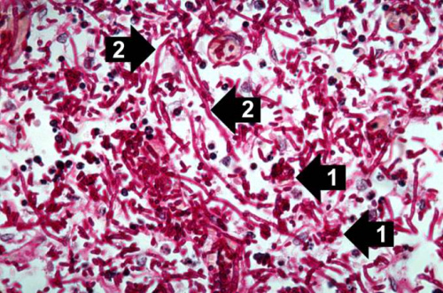 IPLab:Lab 10:Candidiasis - Pathology Education Instructional Resource