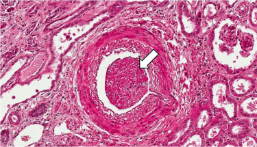 IPLab:Lab 1:Kidney Infarction - Pathology Education Instructional Resource