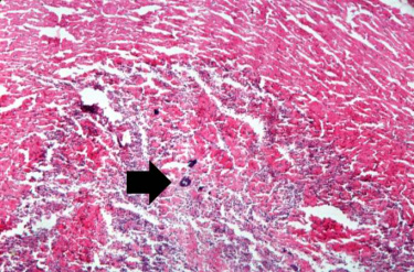IPLab:Lab 4:Septic Emboli - Pathology Education Instructional Resource